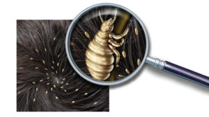 The Next Stage – A Louse-y Problem – The Mom & Caregiver